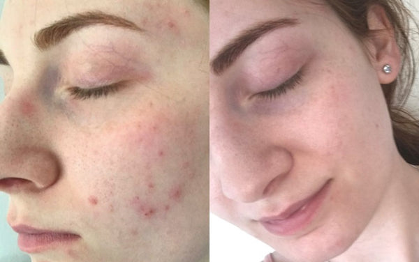 UpCircle results in pictures - UpCircle Beauty
