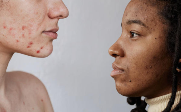 What is Congested Skin? | How to Clear Congested Skin - UpCircle Beauty