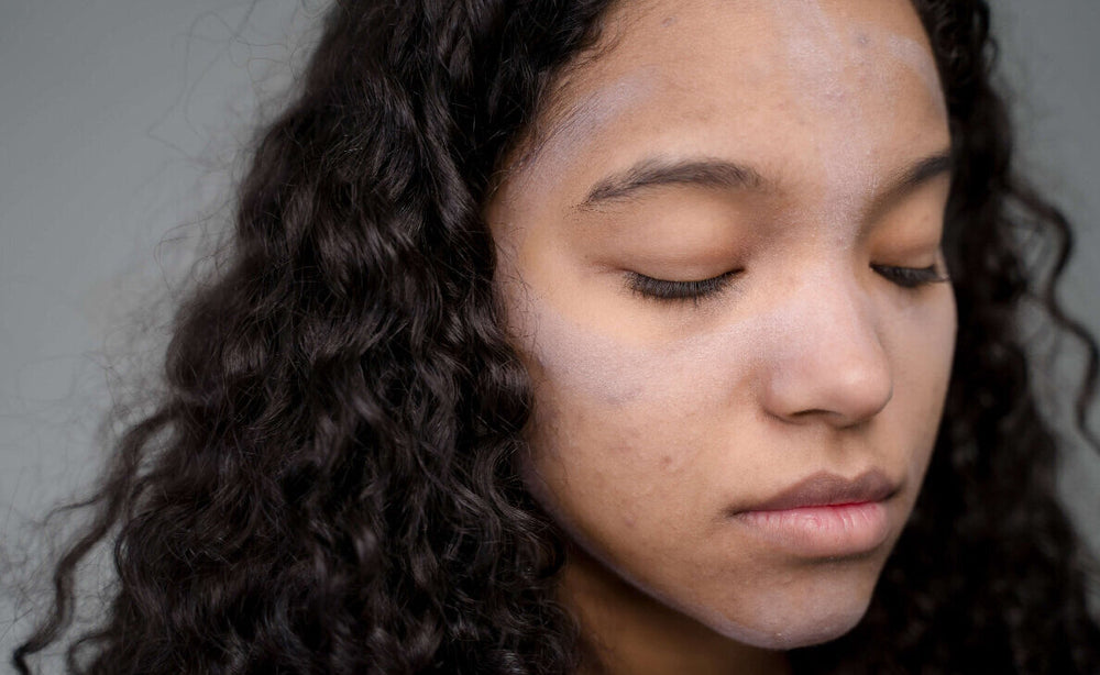 Guide To Common Facial Skin Conditions | UpCircle - UpCircle Beauty