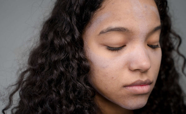 Guide To Common Facial Skin Conditions | UpCircle - UpCircle Beauty