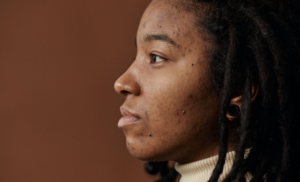 Face Mapping Spots: What Do Your Spots Mean? | UpCircle - UpCircle Beauty